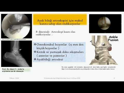 Ankle Arthroscopy - Foot & Ankle - Orthobullets