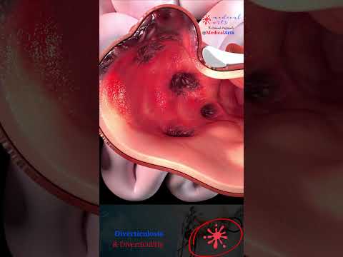 diverticulosis, diverticulitis and diverticular disease.