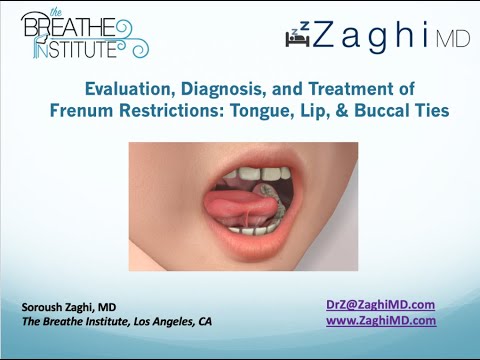 Full Lecture: Evaluation, Diagnosis, and Treatment of Tongue, Lip, & Buccal Ties, Dr. Soroush Zaghi
