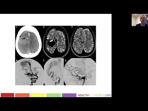 Therapeutic Cerebral, Head and Neck Angiography Part 1| Health4TheWorld Academy