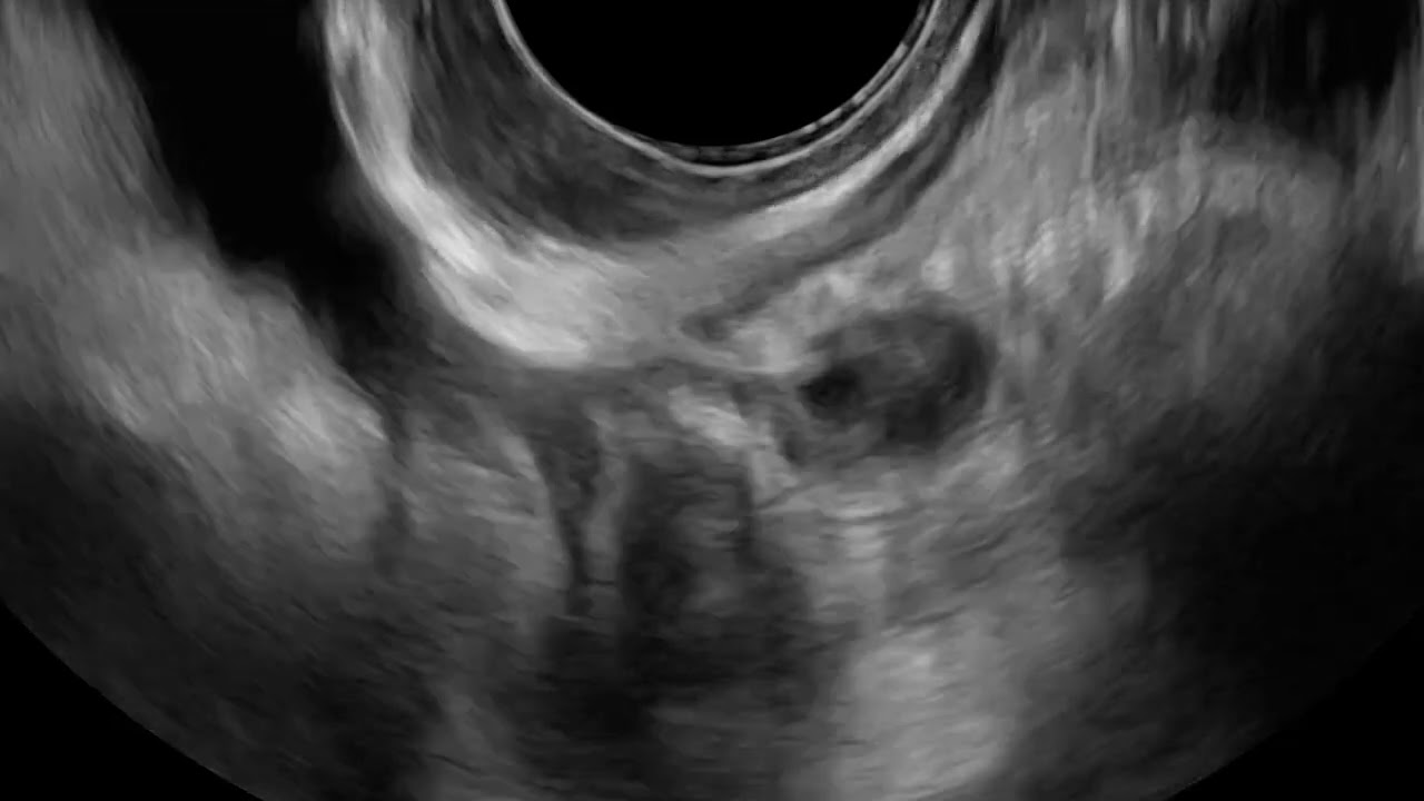 Video 6: Posterior vaginal fornix in deep endometriosis with bowel tethering