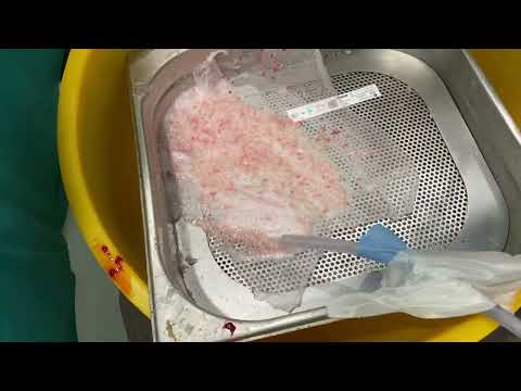 Laser prostate surgery for large 190 gram prostate ( HOLEP)