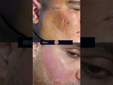 Dermabrasion | Non-invasive Procedure for Acne Scars | Dr. Kamal
