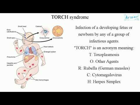 TORCH syndrome