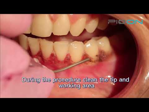 No bleeding and pain-free laser gingival depigmentation procedure performed by Pioon dental laser