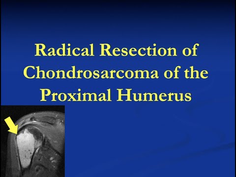 Limb Sparing Resection of the Proximal Humerus due to a Chondrosarcoma