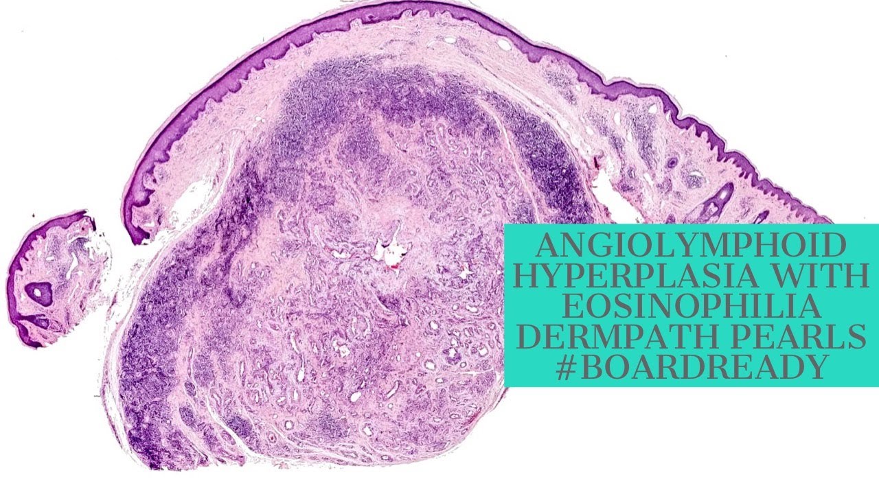 Angiolymphoid hyperplasia with eosinophilia (epithelioid hemangioma) explained by a dermpath