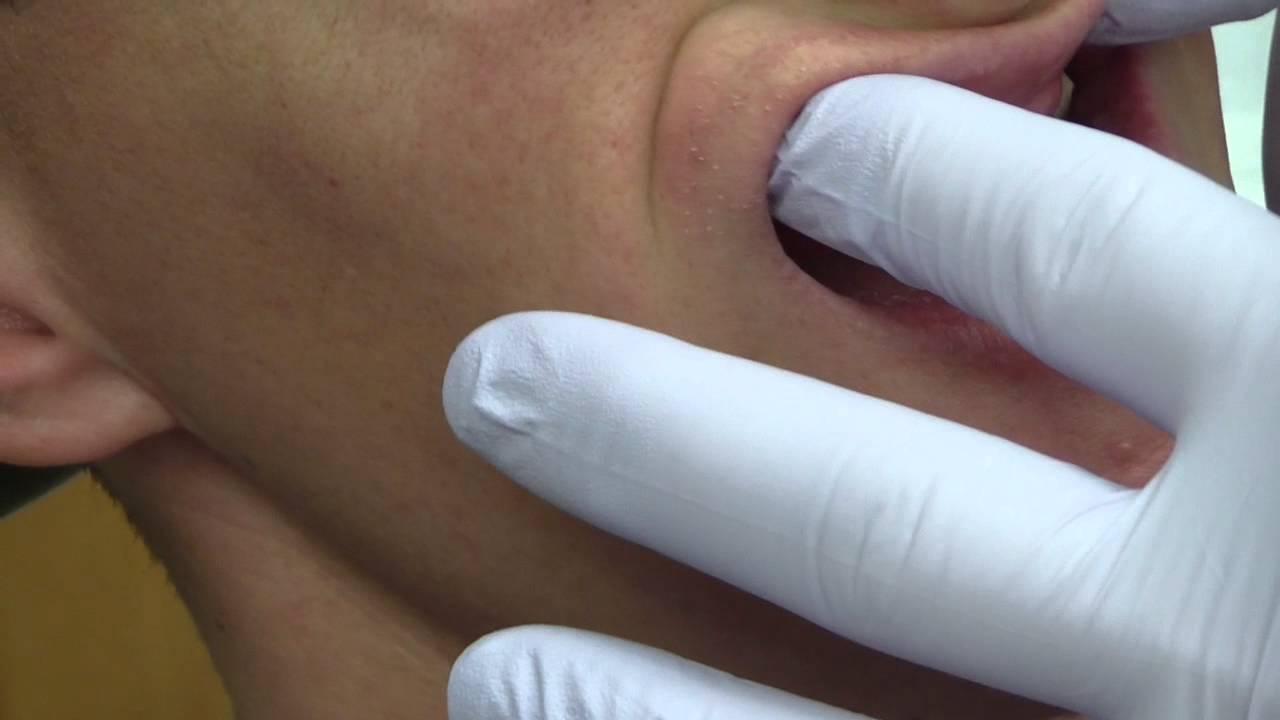 Tooth Supported Overdenture