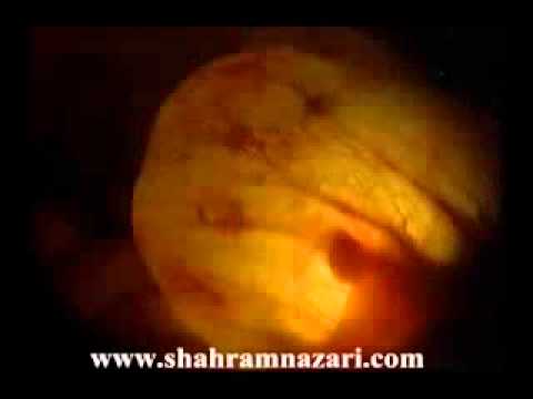 Hybrid Endolaparoscopy Enteroscopy for Cecum Angioectasia