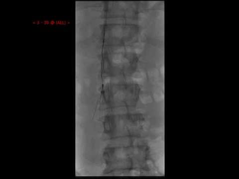 IVC filter retrieval