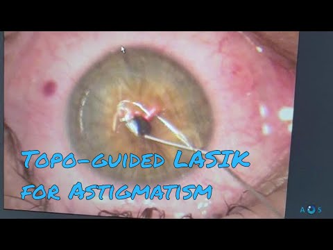 Contoura Vision: Laser Eye Surgery for Astigmatism ( Topography-guided LASIK, PRK)