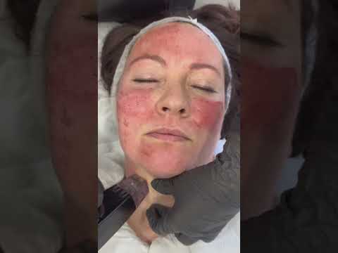 Did you know you can speed up the Morpheus8 Downtime? DrMediSpa