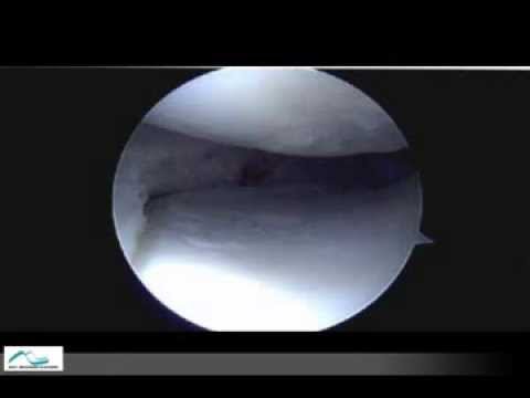 ACL Rehab Forum - Surgery #2: Arthroscopic debridement