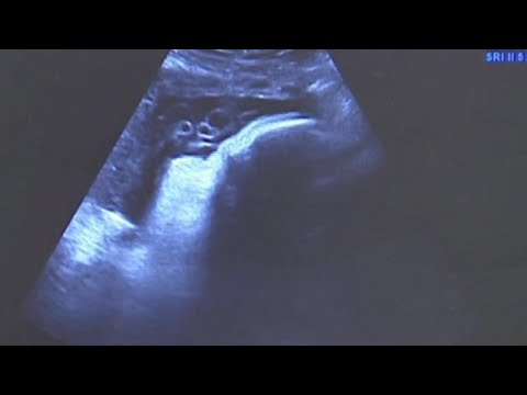 What is postpartum depression and psychosis?