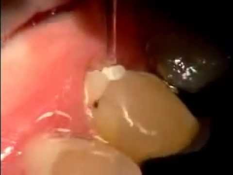 Clínica dental Cuevas Queipo - Láser dental
