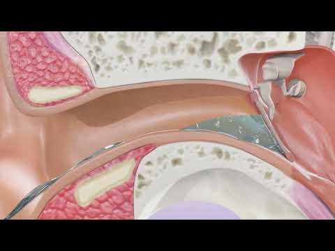 Swimmers Ear