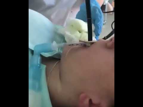 Snake Removed From Stomach | Snake removed from a Woman's GI Tract | Endoscopy #EndoscopicRemoval