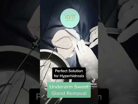 Underarm Sweat Gland Removal