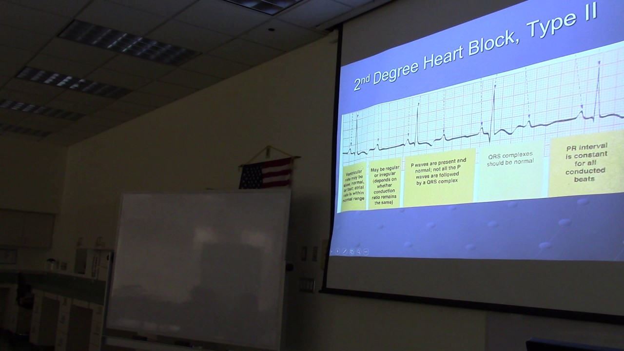 Heart Blocks & Pacemaker Rhythms Part 1