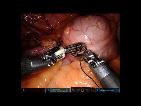 Robotic interval appendectomy