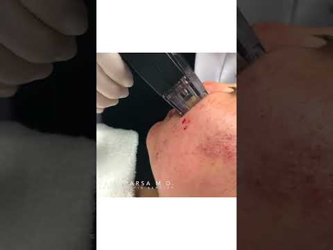Before and After Morpheus8 for Acne | Dr. Kami Parsa, M.D.