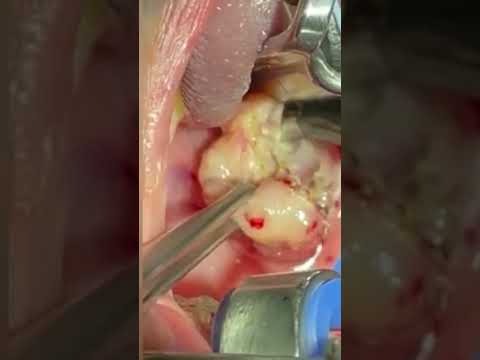 Watch A Real Intracapsular Tonsillectomy Surgery with Expert Explanation