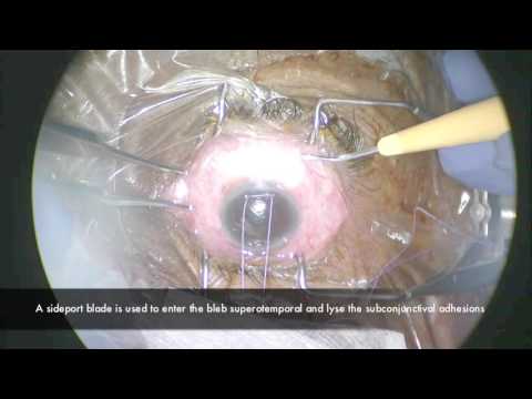 Lysis of Adhesions- Trab Revision 2