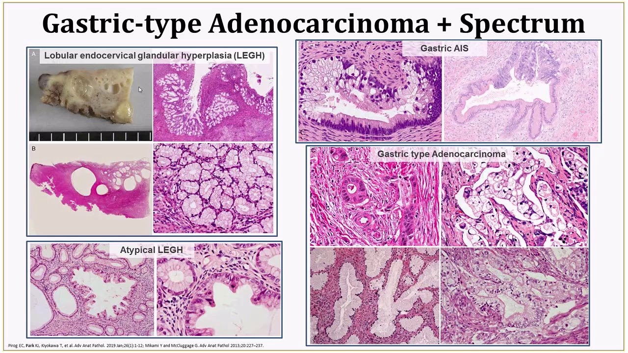 CAP education session Cervix vulva vagina cancer Dr Hoang 2019