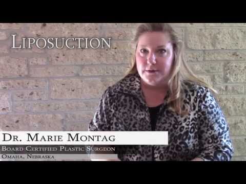 Liposuction: Compression Garments After Surgery