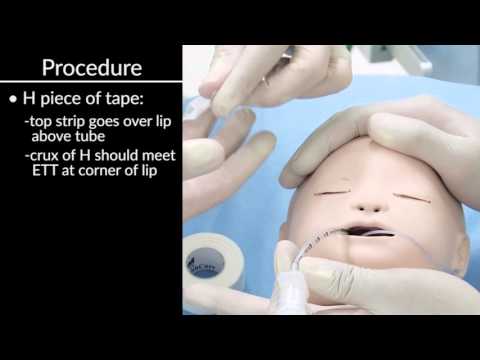 Securing Oral and Nasal Endotracheal Tubes by C. Smallwood | OPENPediatrics