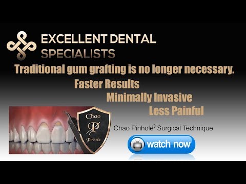 Amazing Alternative To Gum Grafting