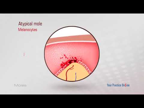 Moles. https://dentalapplica.com/