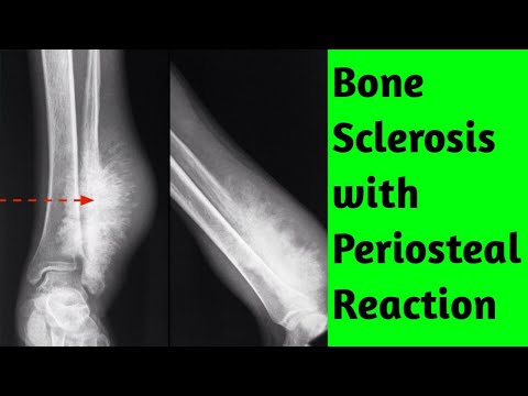 Bone sclerosis with periosteal reaction Differential Diagnosis