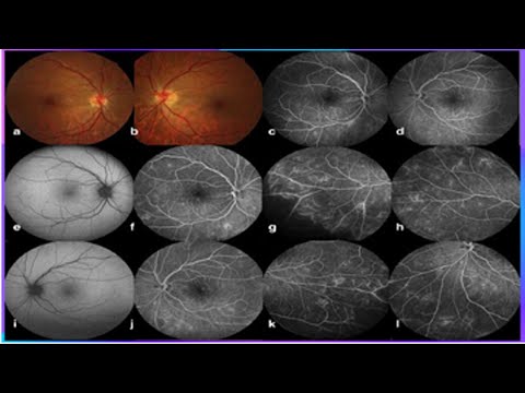 Fundus Fluorescein Angiography FFA Testing