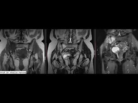 mri pelvis for sacroiliitis