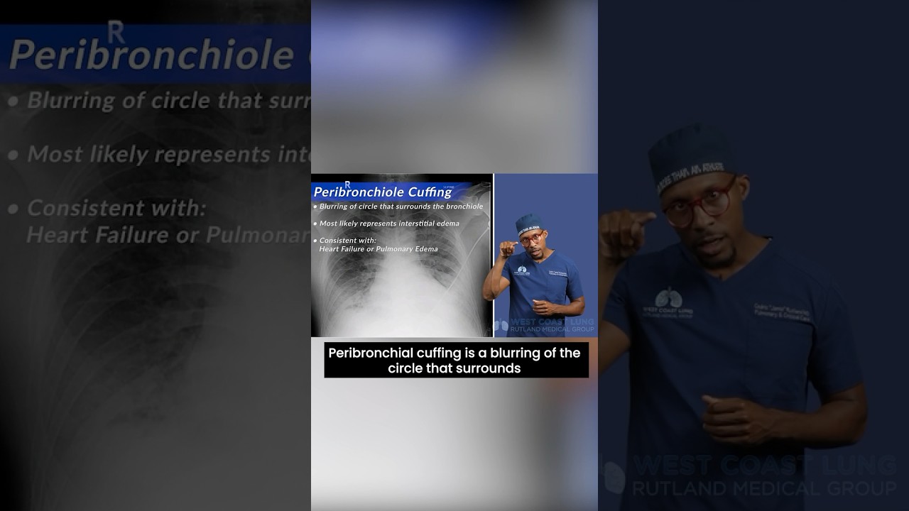 Pulmonary Edema on Chest X-ray:  let’s see what this looks like.  #CHF #edema #heartfailure