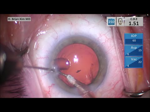 TBWTDCS #68: 1+ Lens Density, Stubborn Cortex, Subincisional Capsule Flush Technique