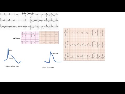 ST elevation on ECG, part 2: case studies