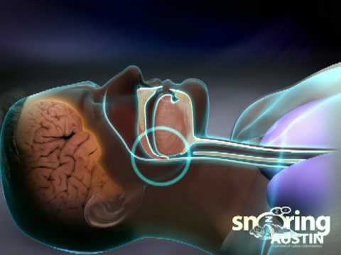 What Causes Snoring and Obstructive Sleep Apnea?
