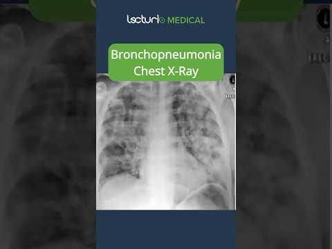 Understanding Bronchopneumonia 🫁 #MedicalEducation #usmle