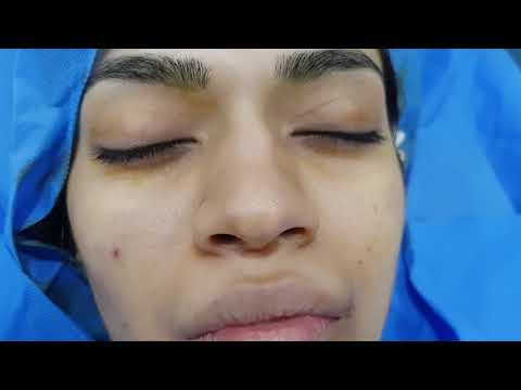 Augmentation Rhinoplasty | Depressed Nose |Wide Nose |Wide Tip |Dr Amin Yousaf Lahore Pakistan