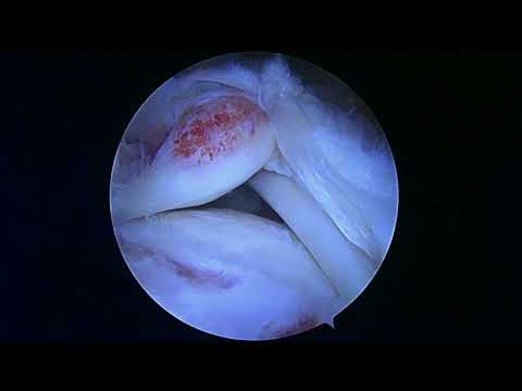 R large rotator cuff repair 1 6 22 TB