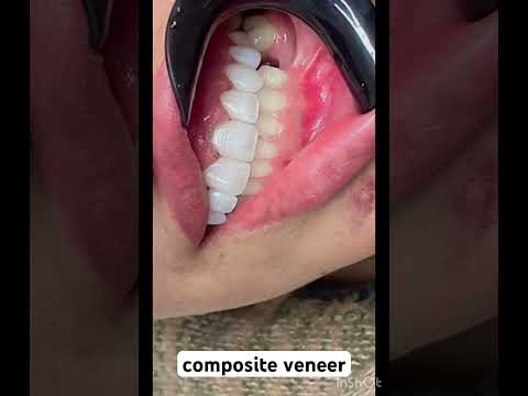 Smile❤️#composite_veneer#ips_composite