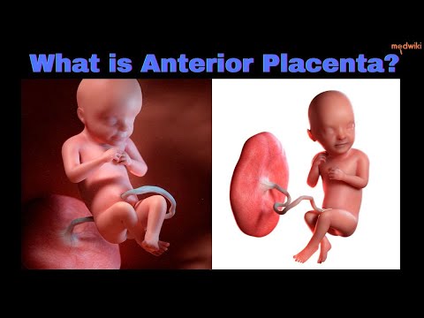 What is an Anterior Placenta?