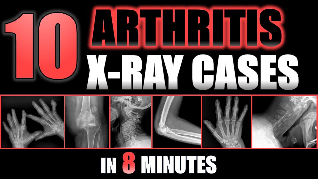 Arthritis X-Ray Cases