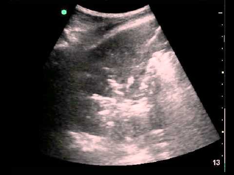 pneumonia hepatization effusion