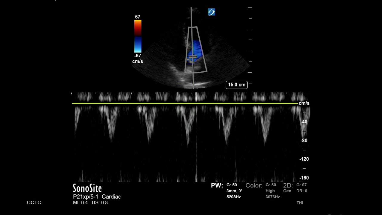 How to... Measure LVOT VTI