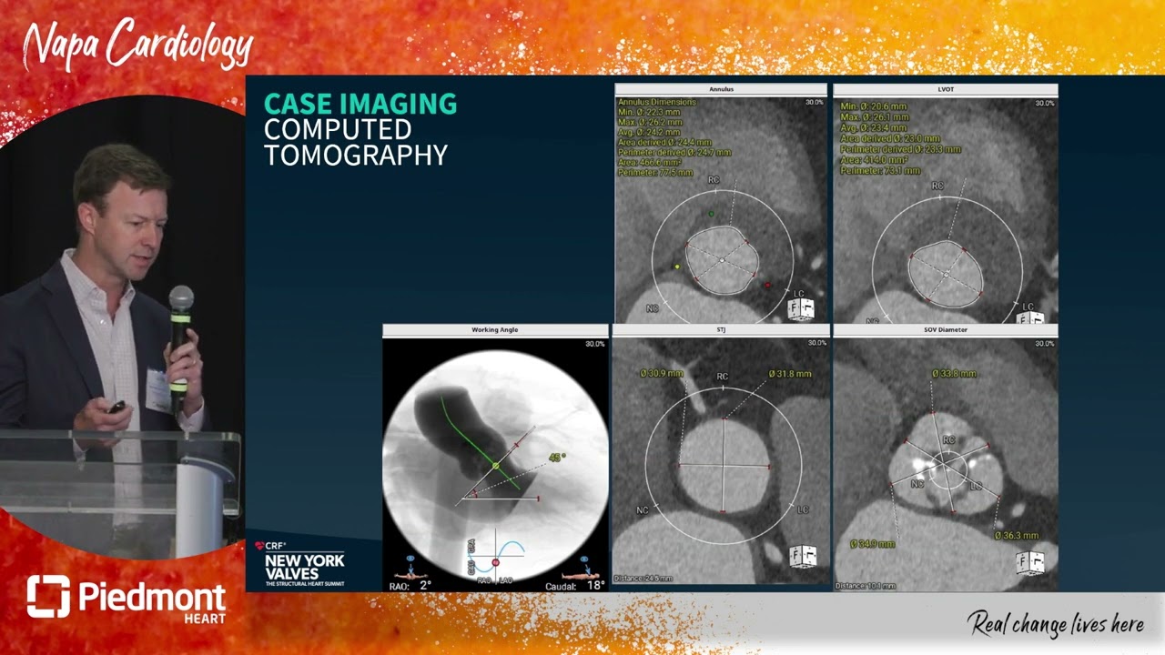 Low Risk Severe Aortic Stenosis: A Case Presentation