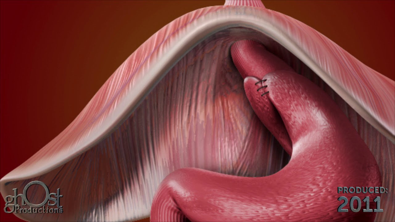 MayoClinic Fundoplication