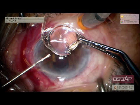 Explantation of a single-piece IOL in the Sulcus causing UGH syndrome. Ahmed Assaf